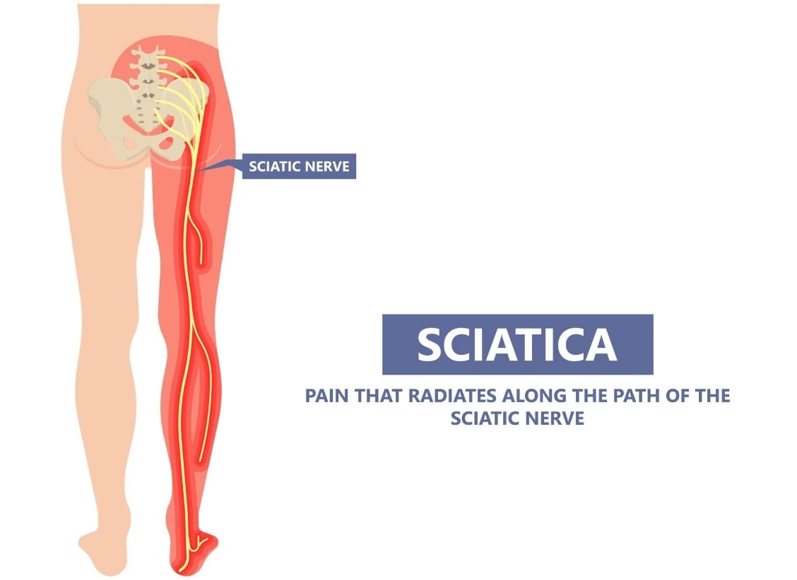 Dry Needling For Sciatica Pain: How it can help you?